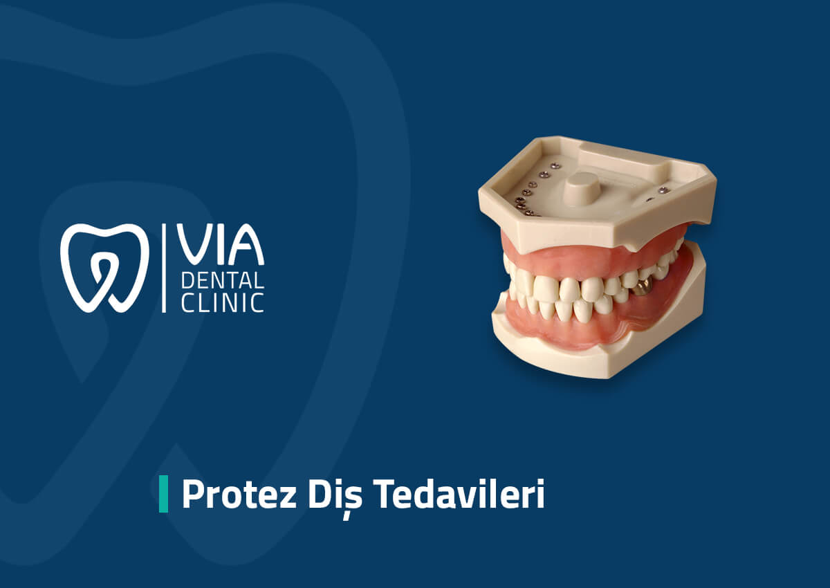 Prosthetic Tooth Treatments – VIA Dental Clinic